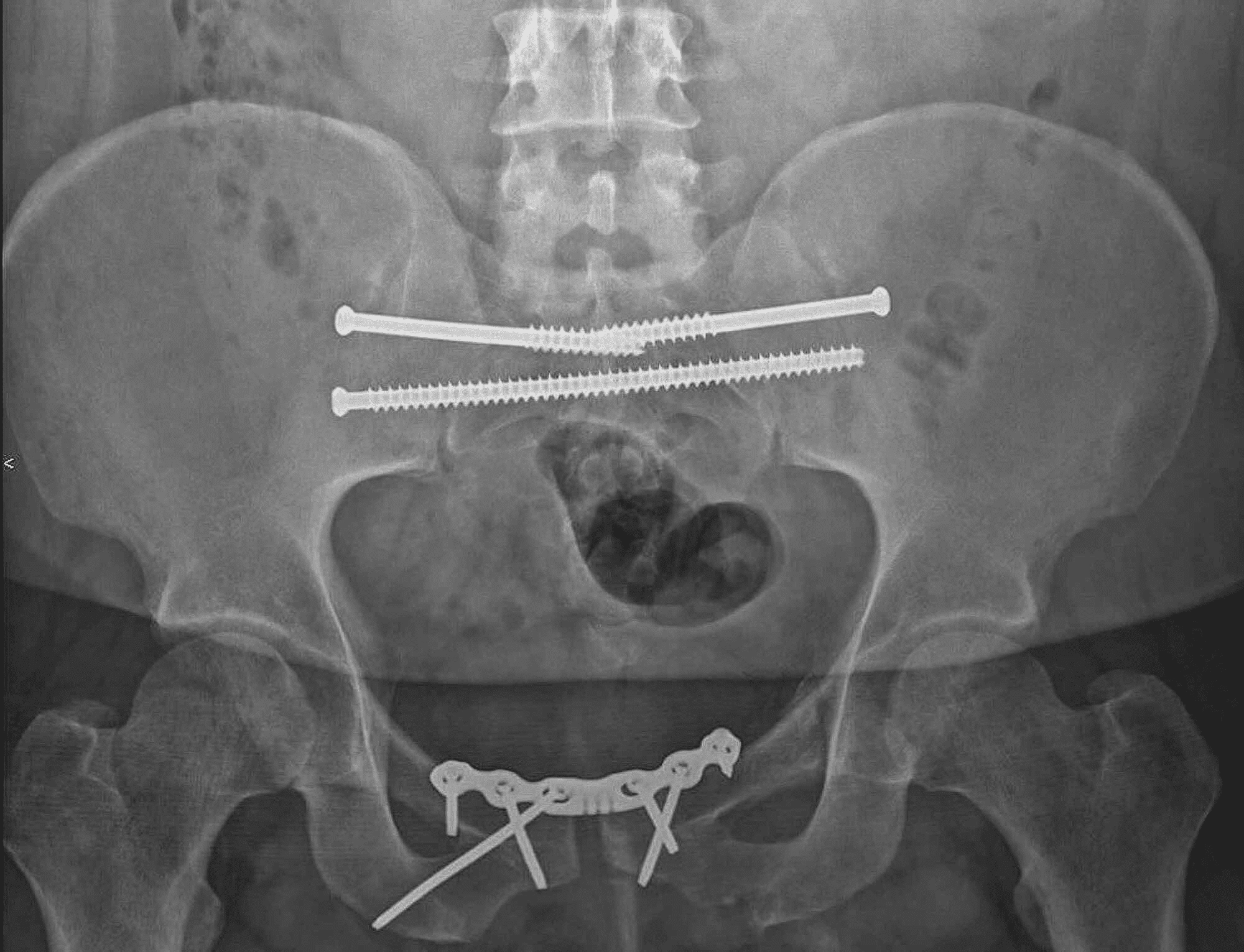Does a pelvic fracture need surgery? - دكتور عمرو امل - آفضل دكتور عظام ...